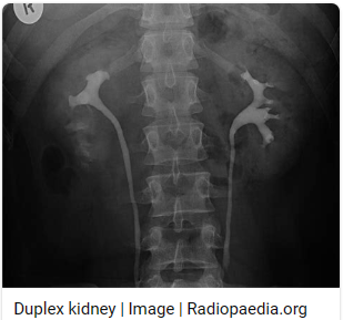开穹 的想法: 肾的4种类型:复肾Duplex kidney,由许多独立的肾叶构成，见于鲸、熊、水獭等。光滑单乳头肾Smooth ...