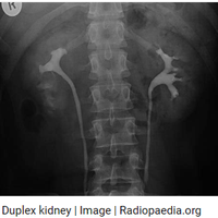 开穹 的想法: 肾的4种类型: 复肾Duplex kidney,由许多… - 知乎