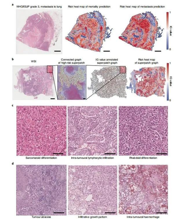 Nat Biomed Eng | AI通过病理切片推导预后和组织病理学特征 - 知乎