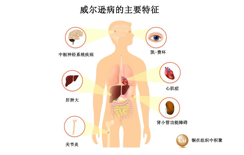 威尔逊病青霉胺替代药！FDA批准Cuvrior(四盐酸盐曲恩汀) - 知乎