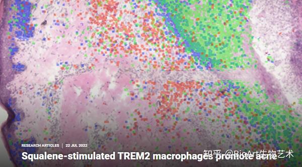 Sci Immuno | 全面分析痤疮中细胞和代谢特征——鲨烯爆痘 - 知乎