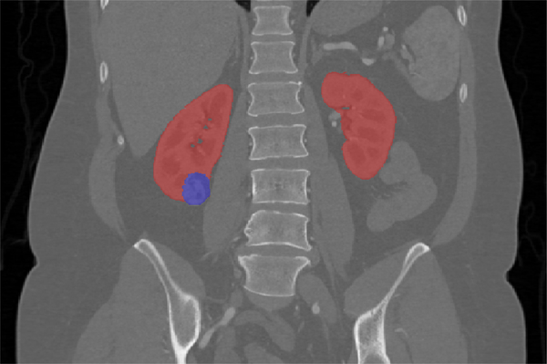KiTS19 数据集介绍 - 知乎