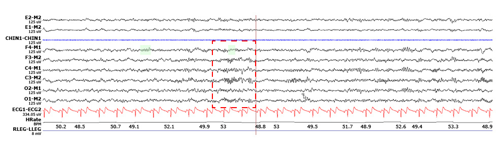 正常睡眠的分期和结构 - 知乎