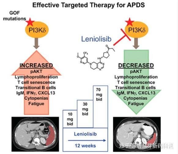 罕见疾病APDS首款特效药通过FDA审批 - 知乎