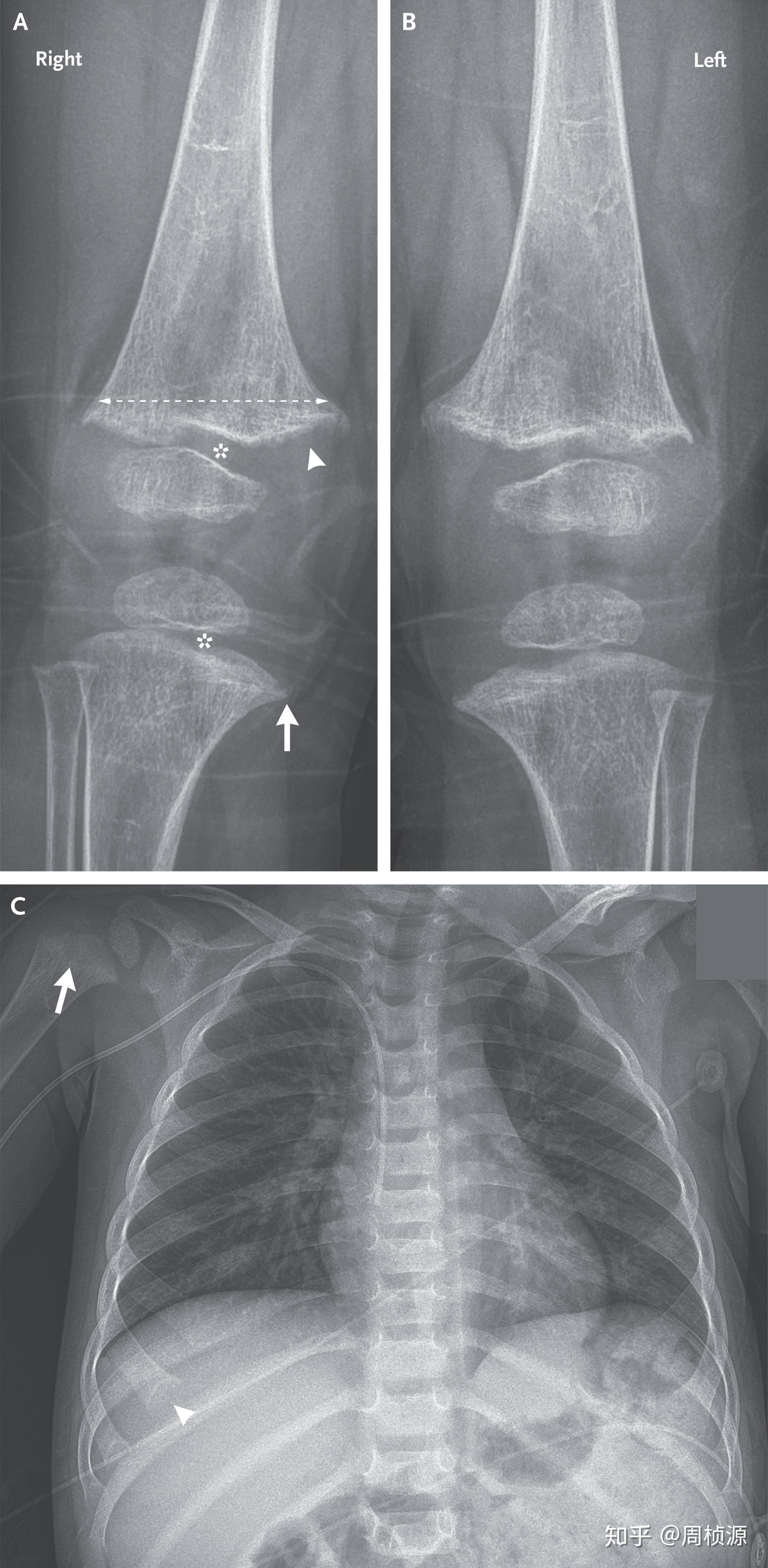 Nejm 2020 Case 39 - 知乎