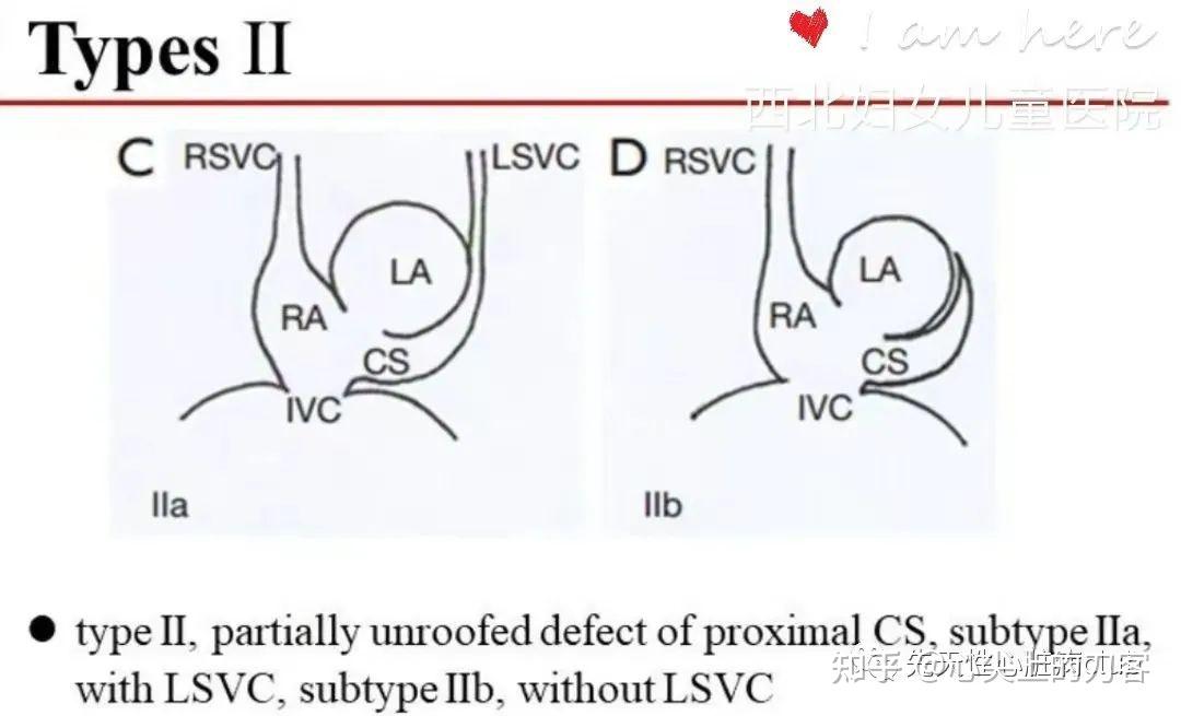 无顶冠状静脉窦综合征（UCSS） - 知乎