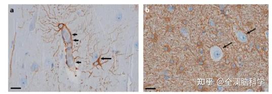 【领域现状】nature Reviews Neurology 星形胶质细胞在癫痫发生和发作过程中的作用 知乎
