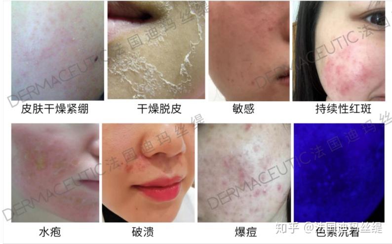 刷酸后通常有哪些皮肤反应？看这一篇就够了 知乎