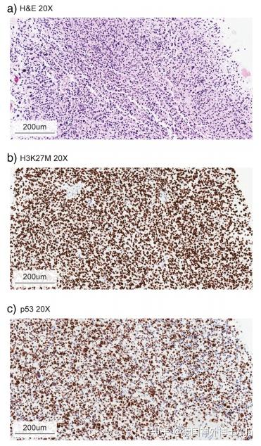 脑干胶质瘤DIPG都有哪些治疗进展？世界知名小儿神外Rutka教授论述 - 知乎