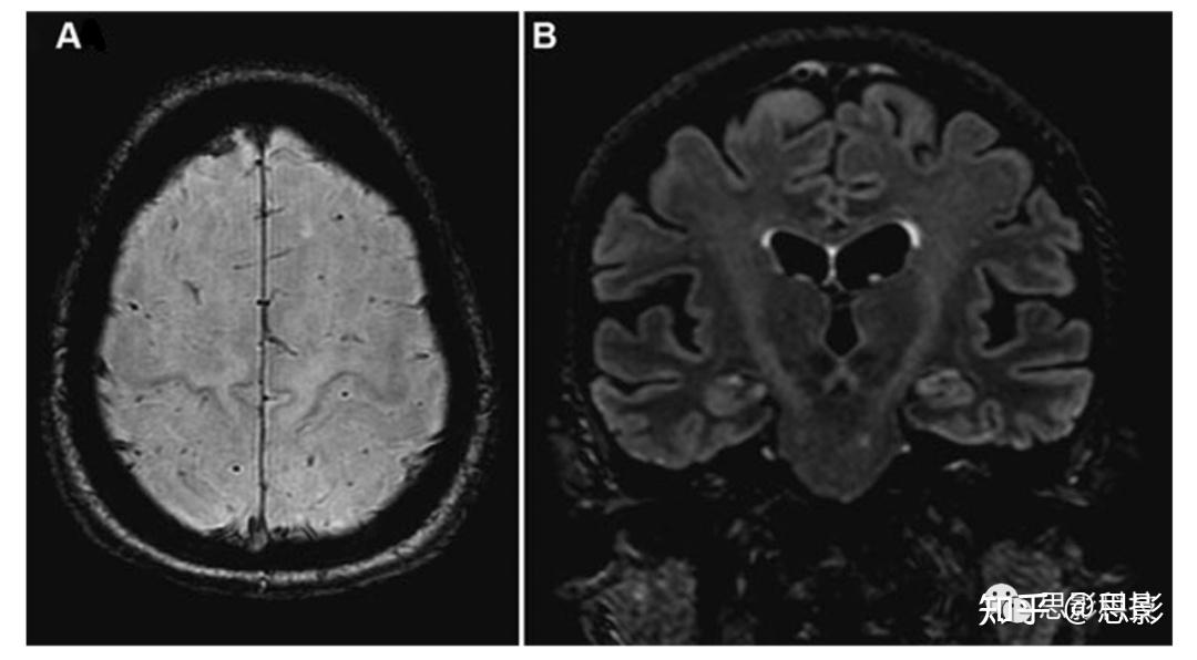磁敏感加权成像（SWI)：技术要点和临床神经学应用 - 知乎