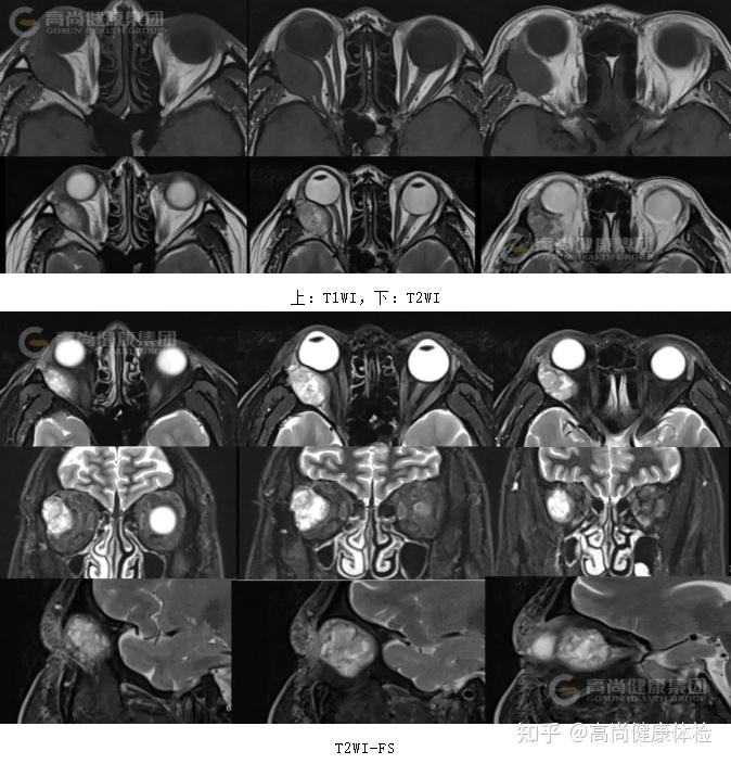 眼眶腺样囊性癌 - 知乎