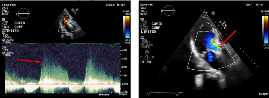 病例丨感染新冠竟引起瓣膜血栓？瓣中瓣TAVR技术成功治疗90岁高龄主动脉生物瓣衰败 - 知乎