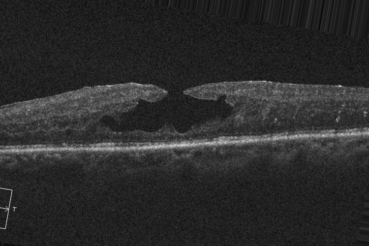 Retinal OCT-C8 数据集介绍 - 知乎