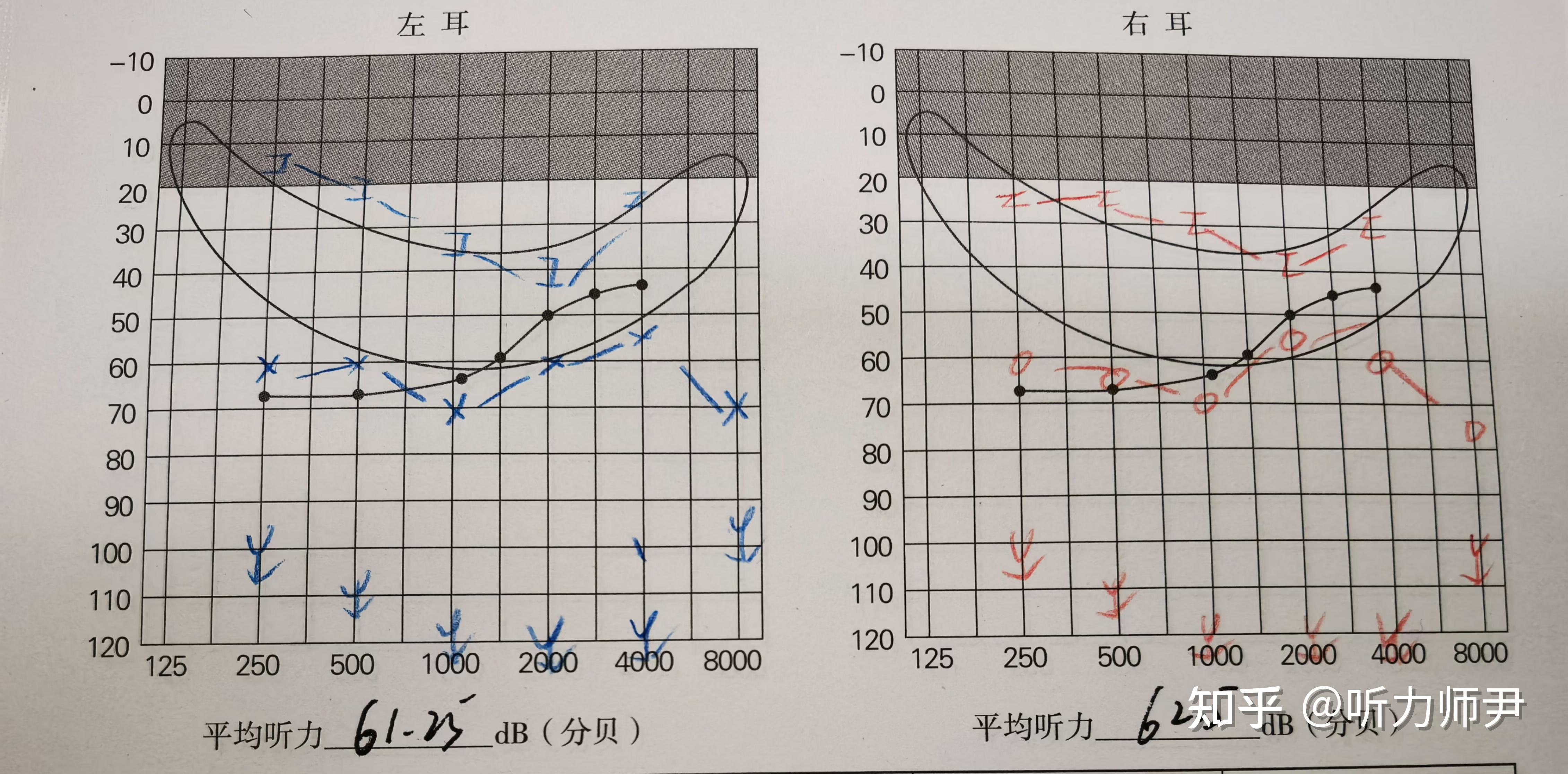 耳硬化症 从诊断到干预 知乎