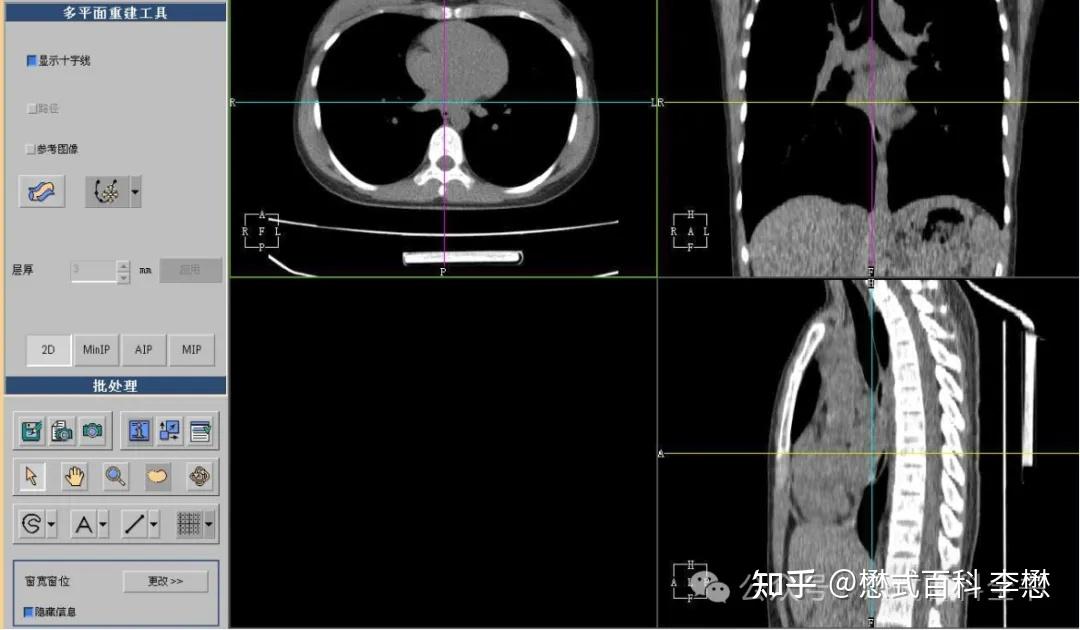 常用的CT图像重建技术及后处理 - 知乎