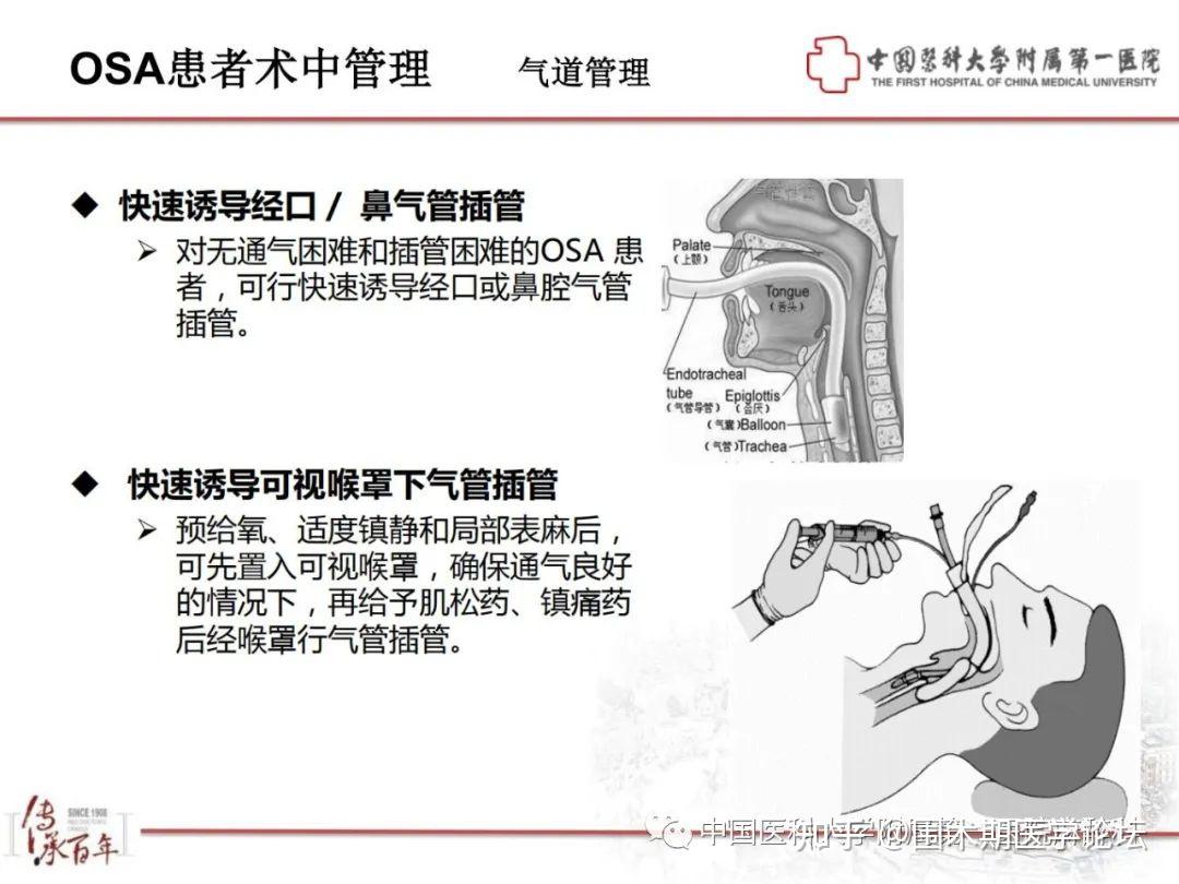 阻塞性睡眠呼吸暂停(OSA)患者围术期麻醉管理(PPT课件) - 知乎