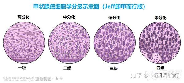 11-3：生死时速！未分化甲状腺癌（ATC）的诊断与治疗 - 知乎