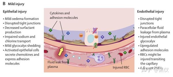 ARDS的病因、病理生理学特征与表型文献综述 - 知乎