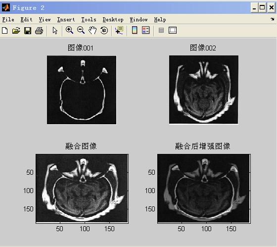 CT与MRI图像融合matlab程序及结果 - 知乎
