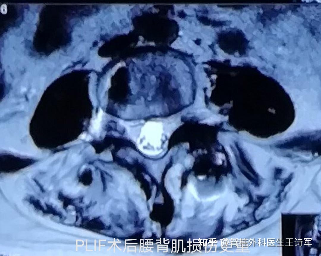 MIDLF比PLIF手术对腰背肌损伤更小 - 知乎