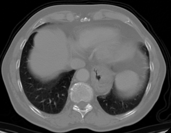 Chest CT-Scan images 数据集介绍 - 知乎