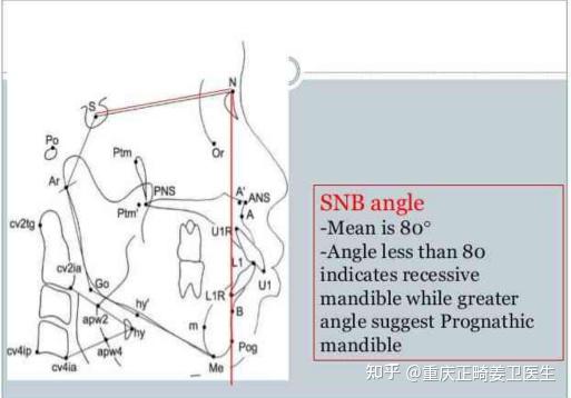 重庆牙齿矫正(正畸）|你的嘴凸是牙性还是骨性?怎么通过SNA、SNB、ANB角判断面型？ - 知乎
