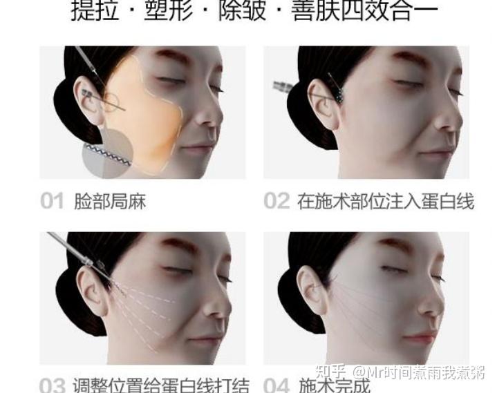 科普篇：ppdo线雕是什么线？ppdo线雕维持时间？ - 知乎