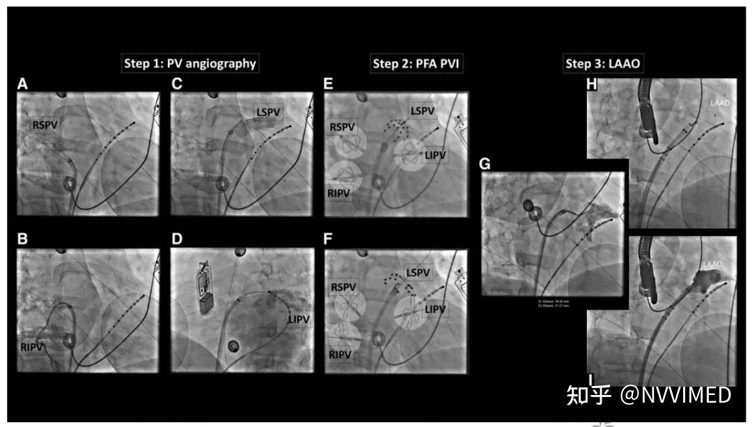 2025年房颤PFA脉冲场消融国际专家实践指南，详解PFA消融新流程！ - 知乎