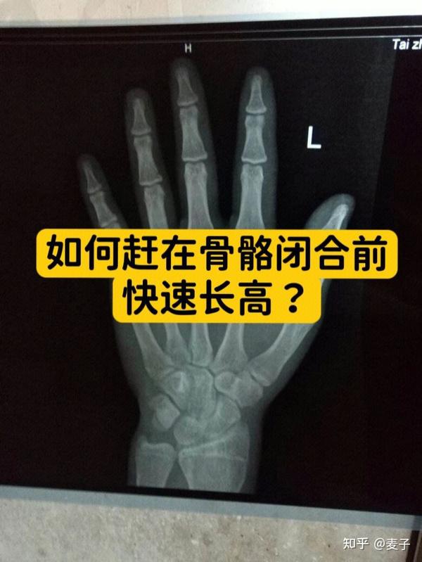 骨骼闭合前,这样做能快速长高 知乎
