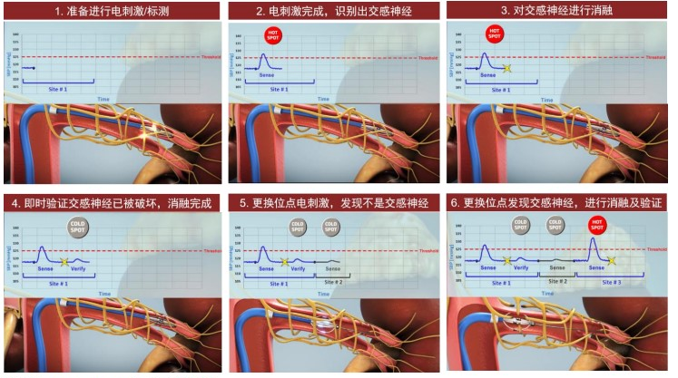 RDN | 经肾动脉去交感神经术——高血压微创介入治疗 - 知乎