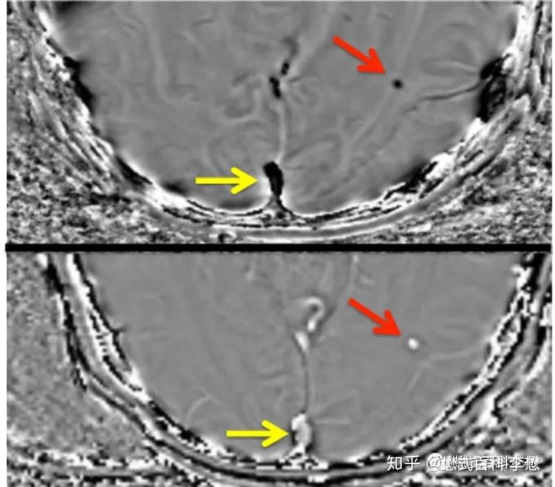 SWI序列原理及临床应用 - 知乎