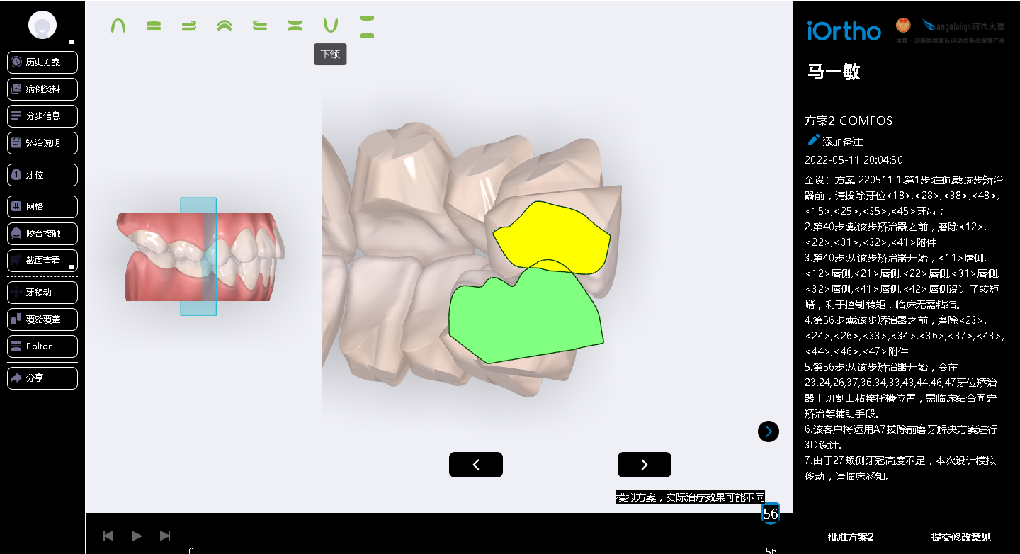 时代天使iOrtho10.0探究+患者正畸方案索取细节 - 知乎