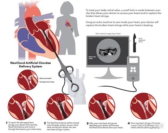二尖瓣介入治疗行业研究报告 - 知乎