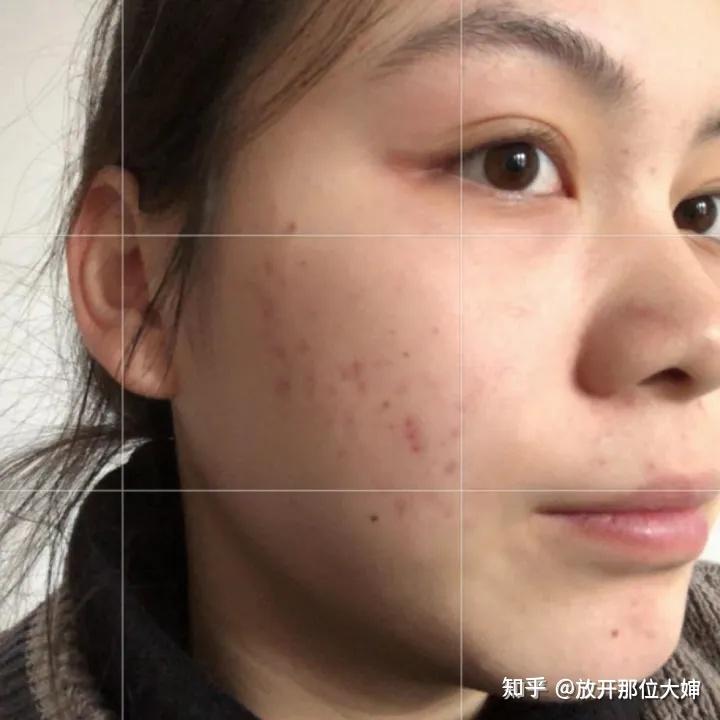 皮肤屏障严重受损,脸上红色痘印多到能调色,怎么快速解决这种情况??? 知乎