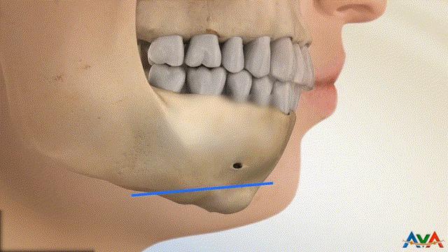 正颌手术都有哪些术式？这组动图让你一目了然！ - 知乎