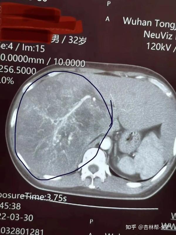 记一例没做一期手术的“ALPPS”手术 - 知乎