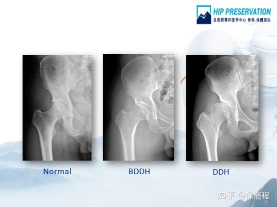 什么是临界DDH？ 直播1-1 - 知乎