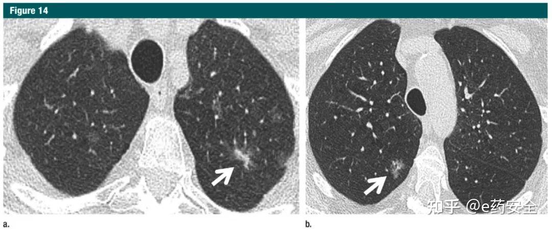 Fleischner指南：CT检出偶发性肺结节的管理①（中文） - 知乎