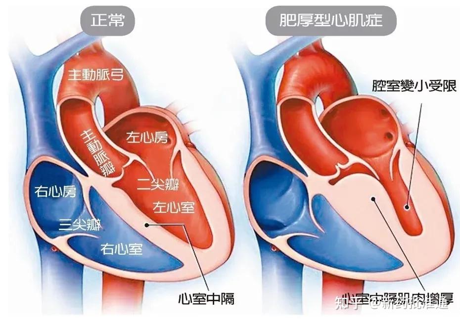【NMPA新药】肥厚型心肌病全球创新药玛伐凯泰在中国获批上市 - 知乎