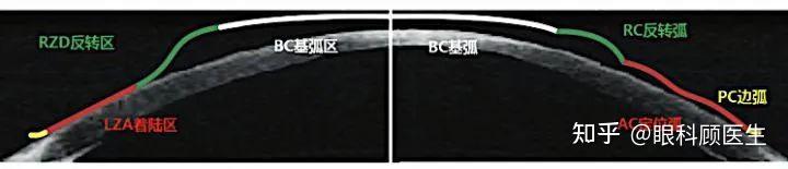 各类不同品牌的OK镜汇总及选择 - 知乎