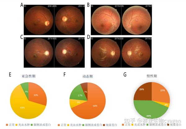 【罕见病并不罕见】Leber遗传性视神经病变(LHON)——不在染色体上的遗传性疾病 - 知乎