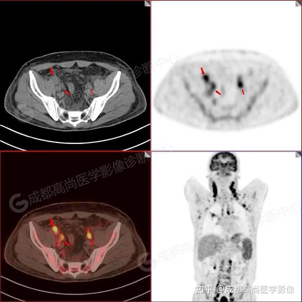 【高尚病例】全身多部位结核PET/CT显像一例 - 知乎