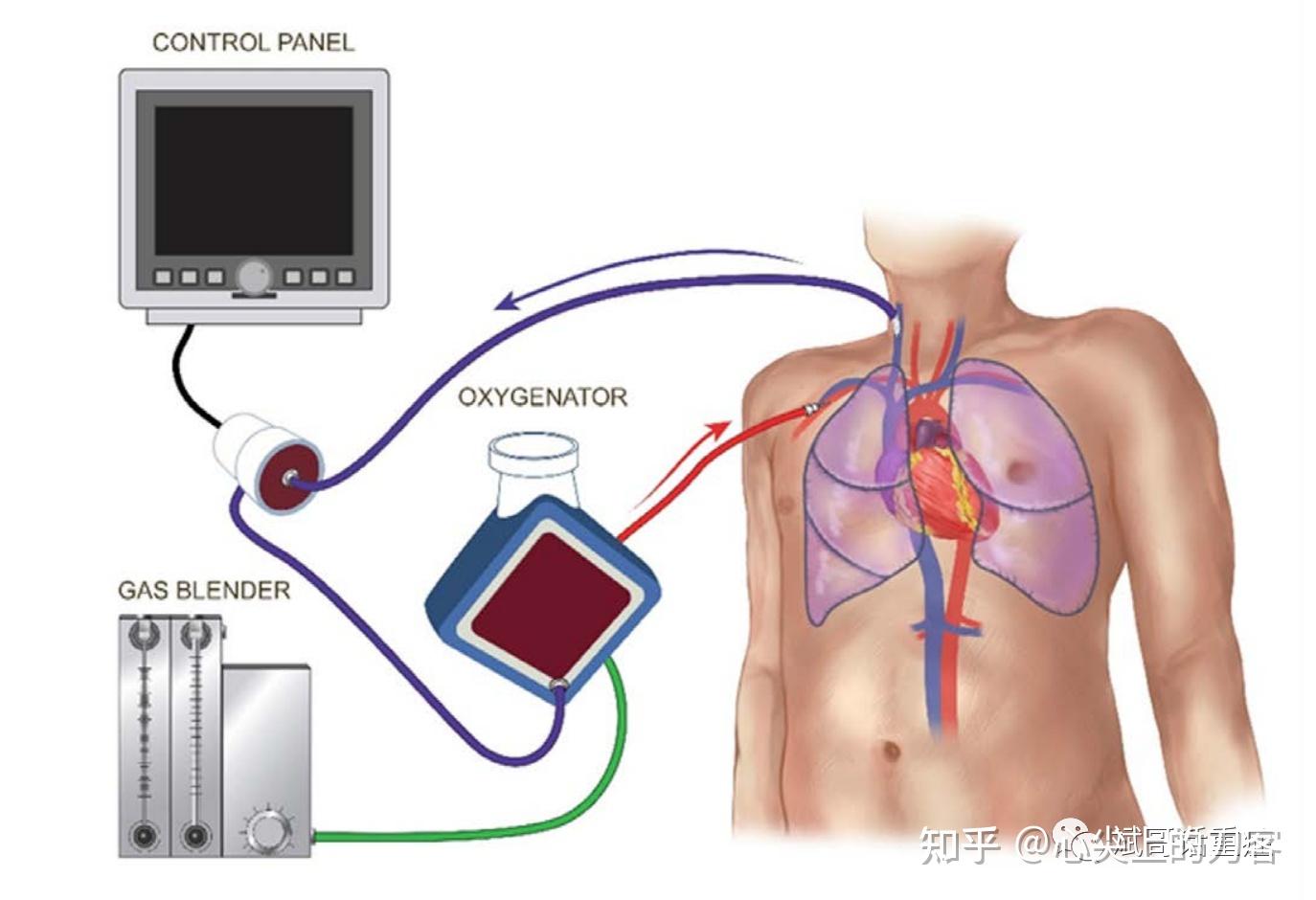 ELSO 成人和儿童体外膜氧合回路指南 - 知乎