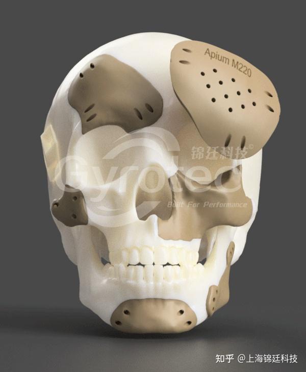 医疗新突破 ! 3D打印PEEK颈椎植入物获FDA批准 - 知乎