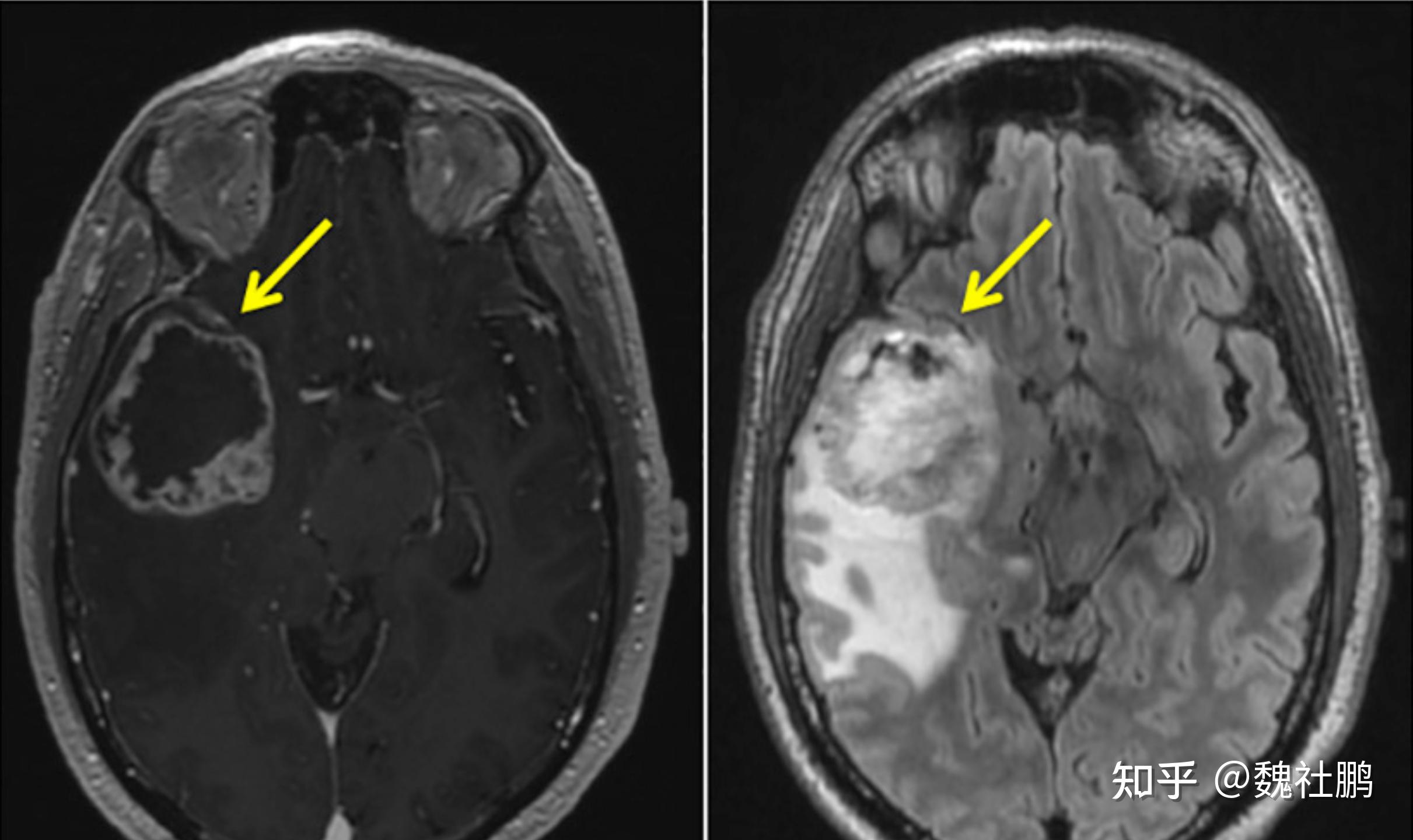2022年10月更新的胶质母细胞瘤的治疗指南 - 知乎