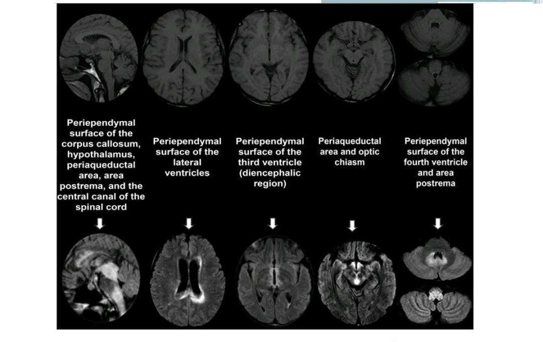 神内临床笔记11 胼胝体病变 - 知乎
