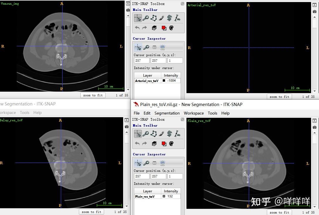 FSL用于脑部MRI图像配准: （flirt与ants刚性与弹性配准） - 知乎
