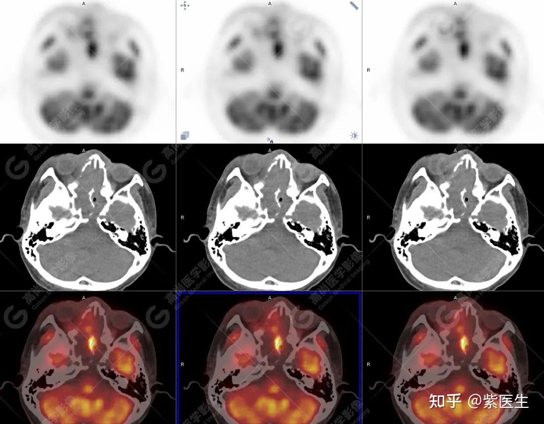 【高尚医学影像病例】PET-CT/MR增强多模态诊断结外NK/T细胞淋巴瘤复发一例 - 知乎