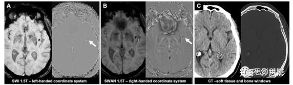 磁敏感加权成像（SWI)：技术要点和临床神经学应用 - 知乎
