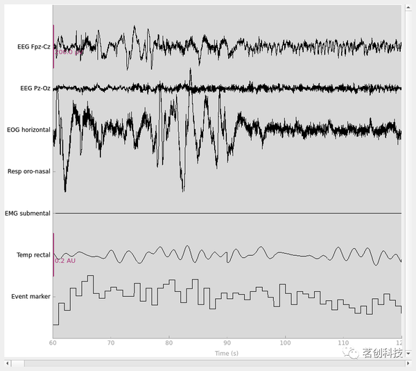 多导睡眠图（PSG）数据的睡眠阶段分类 - 知乎